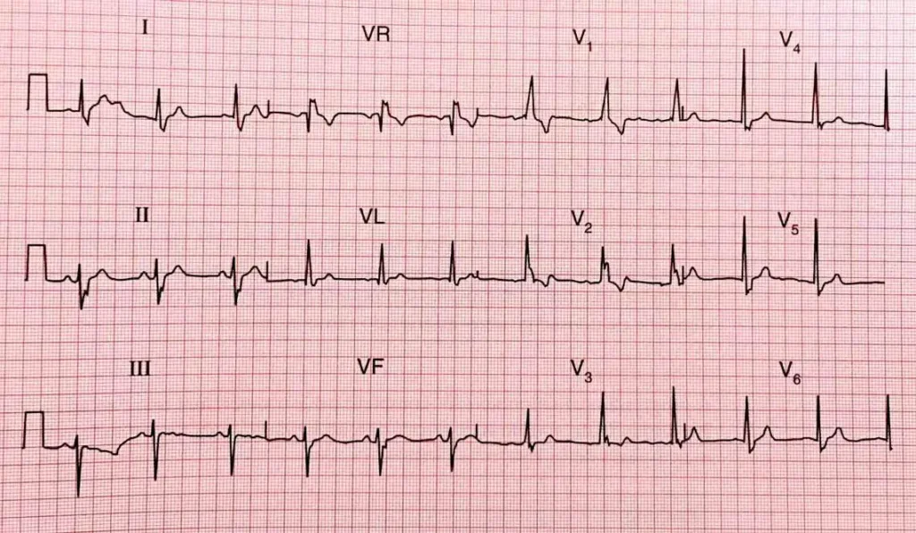Eletrocardiograma: Como Funciona e Interpretação - Biomedicina Online