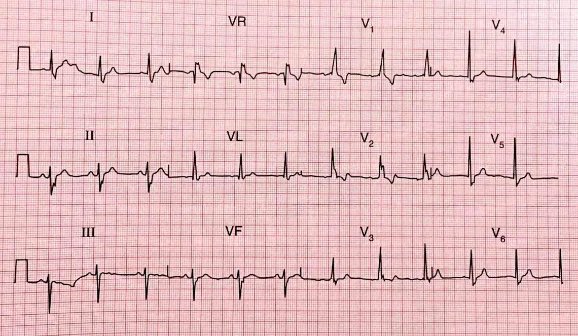 Eletrocardiograma: Como Funciona e Interpretação - Biomedicina Online